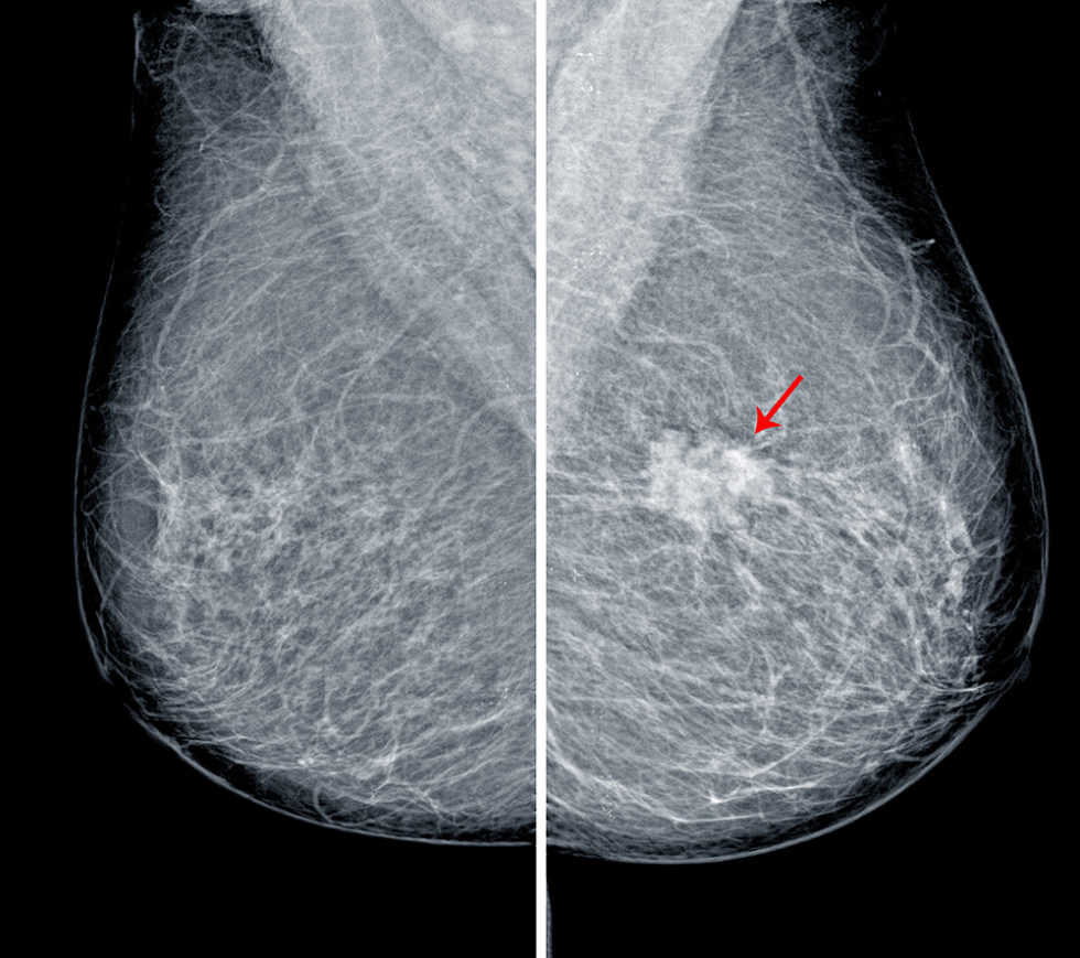 Mammographie et tomosynthèse - Imvoc